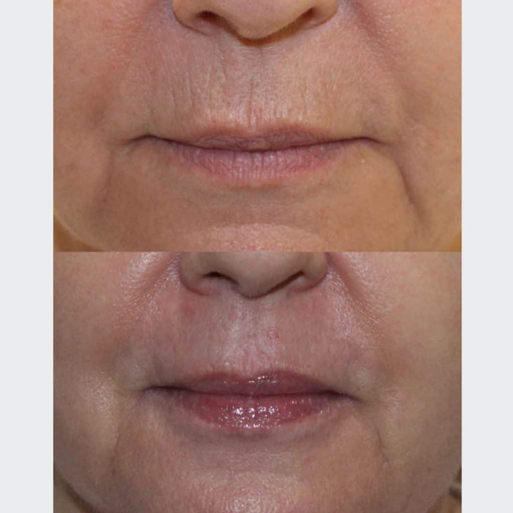 Perioral/Lip Rejuvenation Gallery - Dr Davin Lim