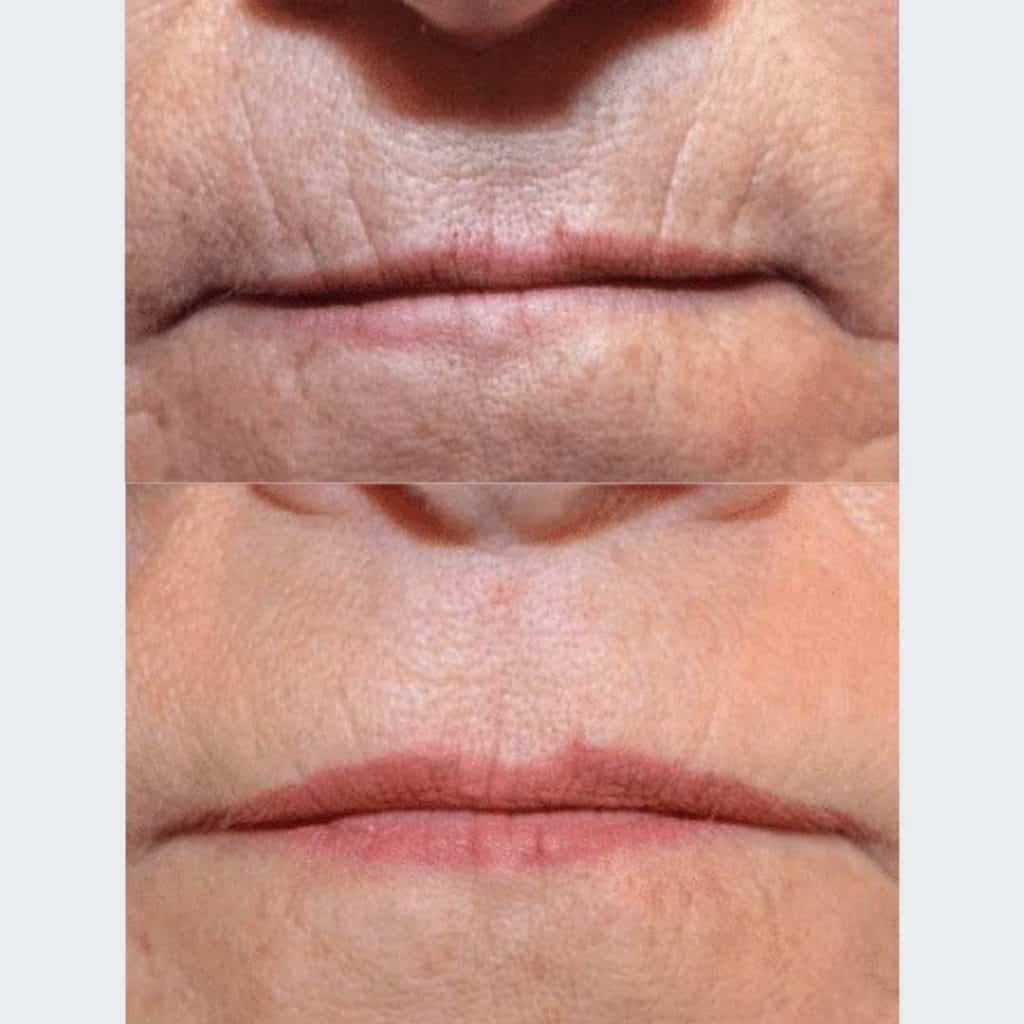 Perioral/Lip Rejuvenation Gallery - Dr Davin Lim