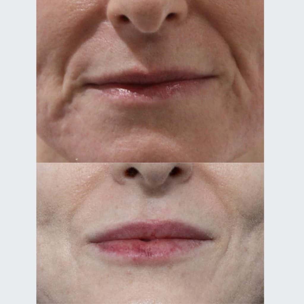Perioral/Lip Rejuvenation Gallery - Dr Davin Lim