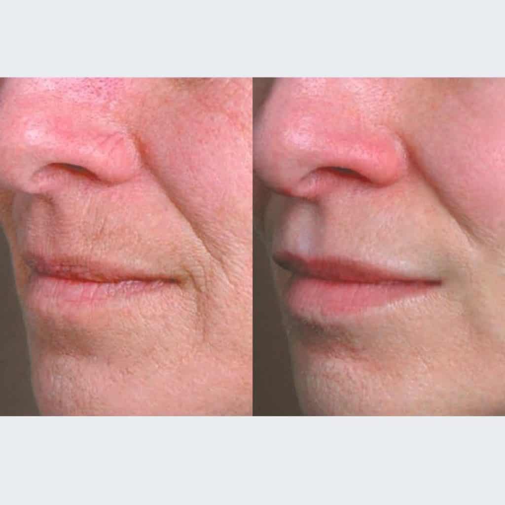 Perioral/Lip Rejuvenation Gallery - Dr Davin Lim