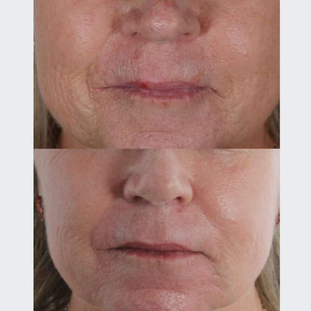 Perioral/Lip Rejuvenation Gallery - Dr Davin Lim