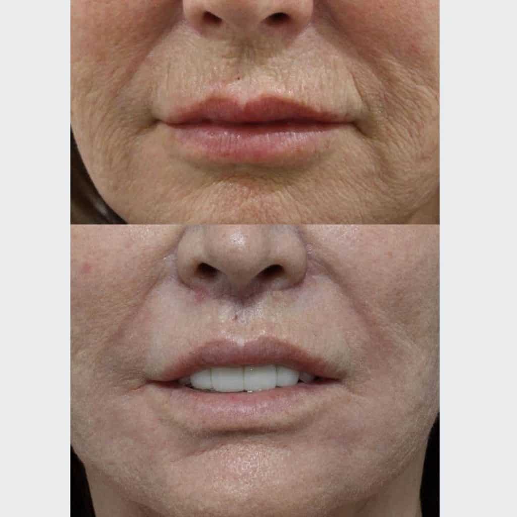 Perioral/Lip Rejuvenation Gallery - Dr Davin Lim