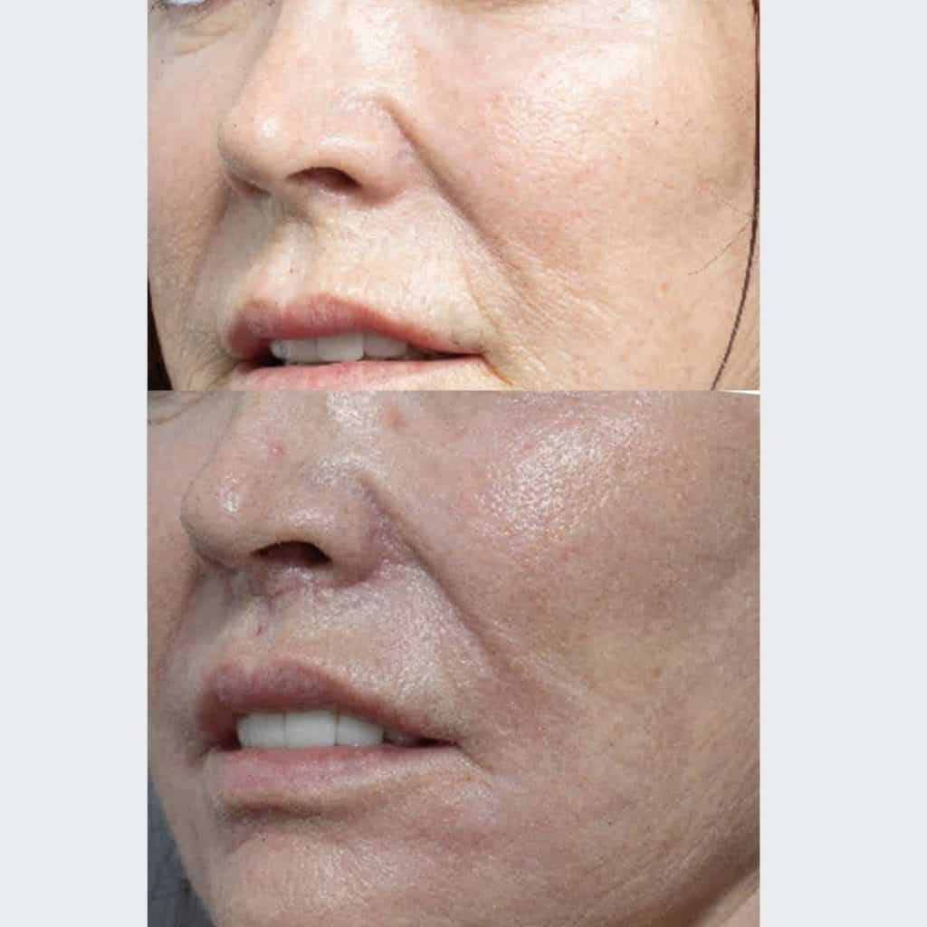 Perioral/Lip Rejuvenation Gallery - Dr Davin Lim