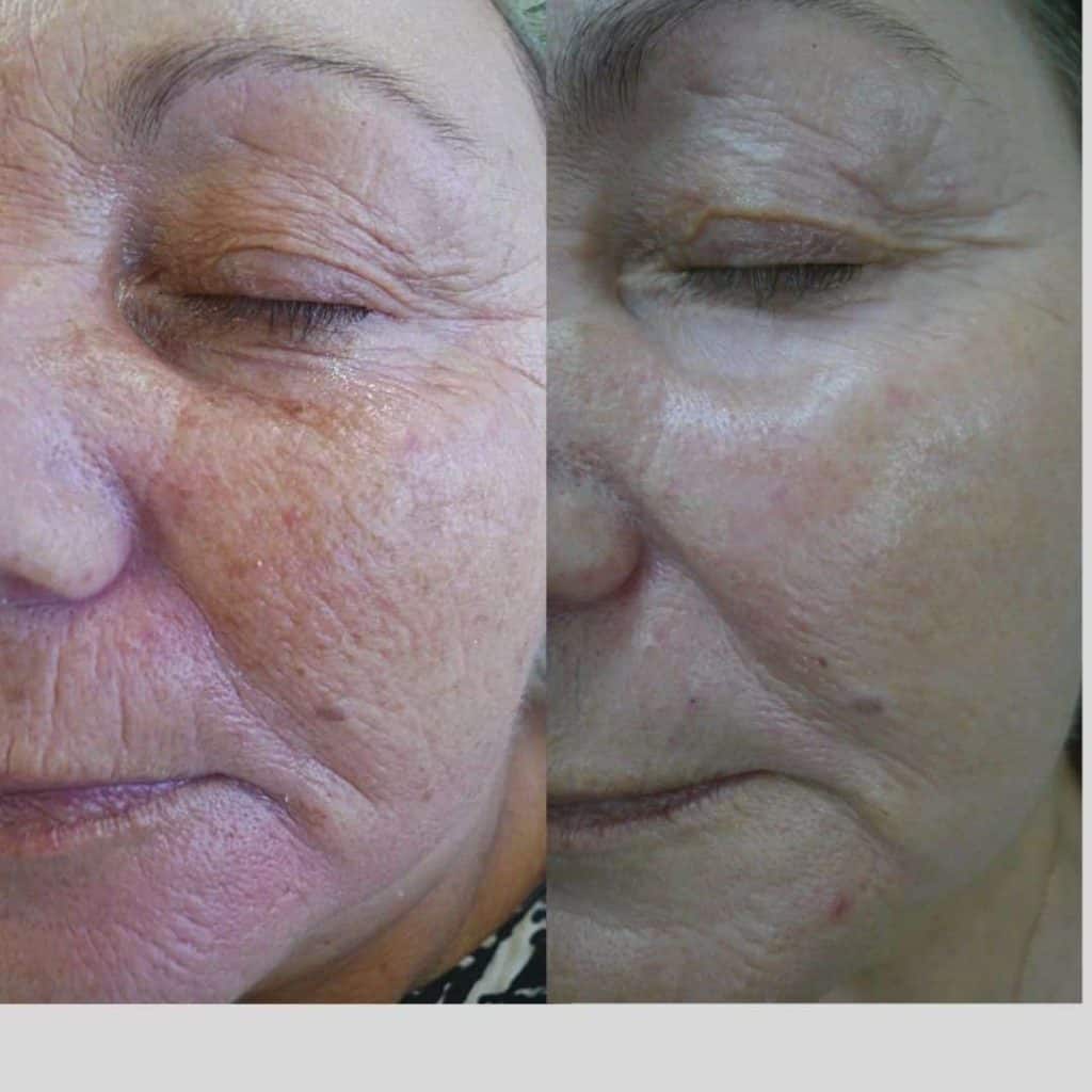 Perioral/Lip Rejuvenation Gallery - Dr Davin Lim