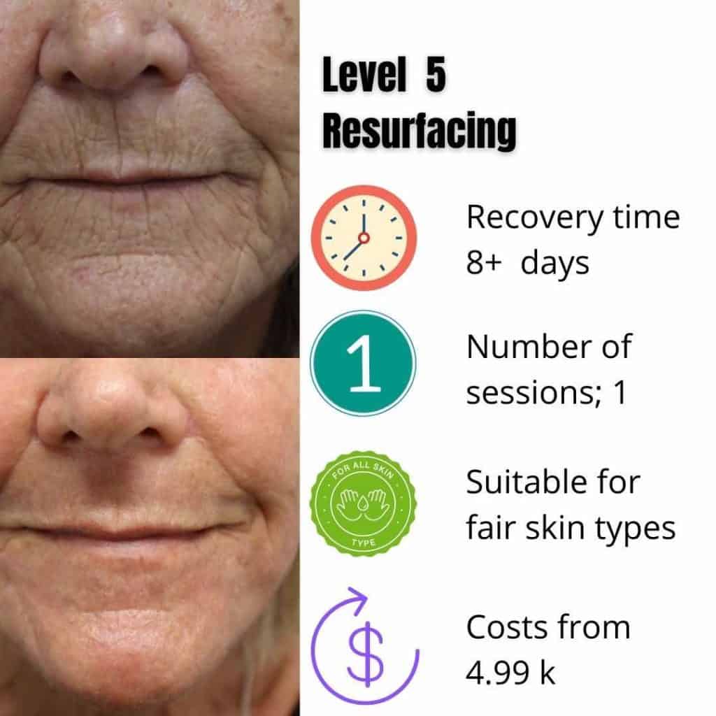 Perioral/Lip Rejuvenation Gallery - Dr Davin Lim