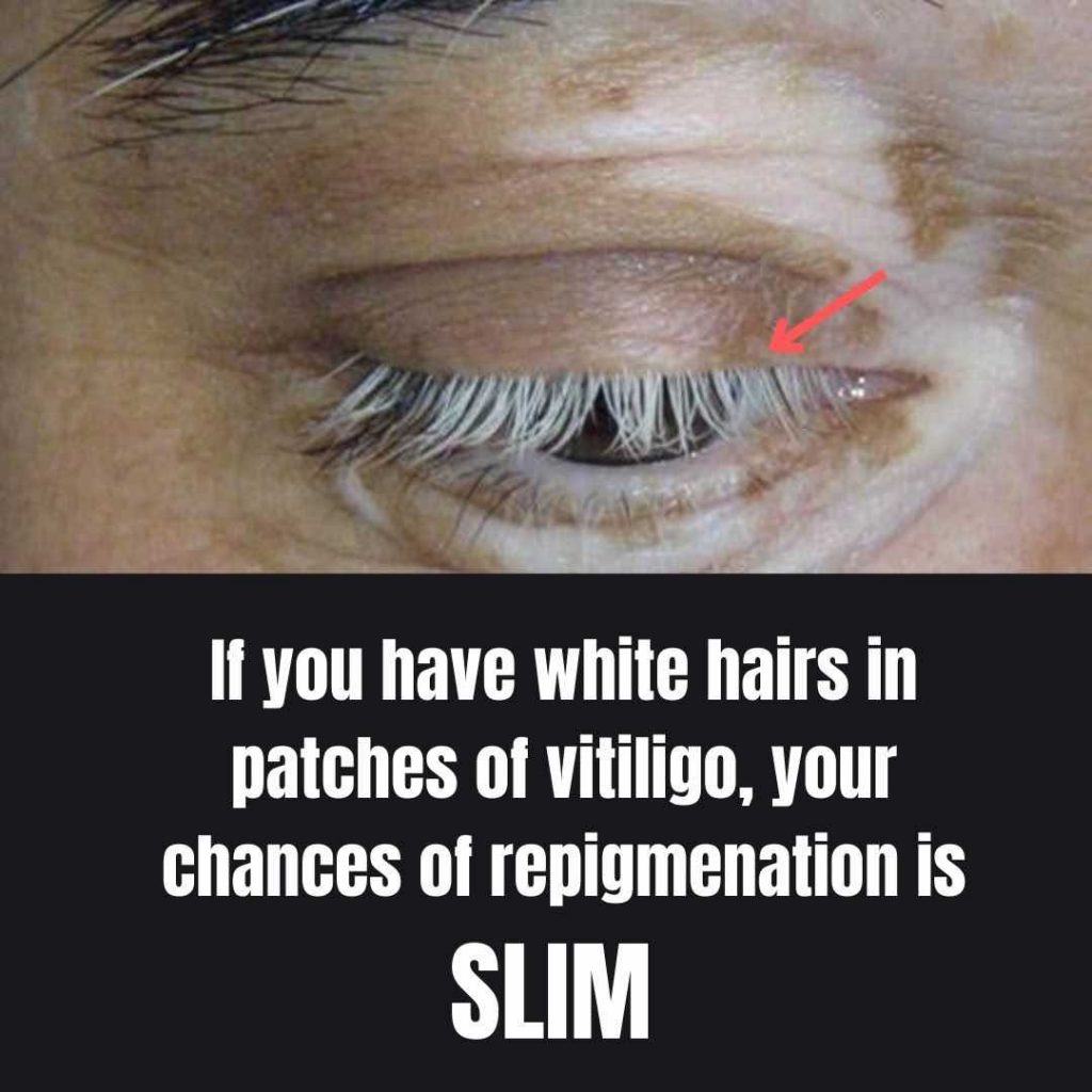 Vitiligo & White Hairs - Dr Davin Lim
