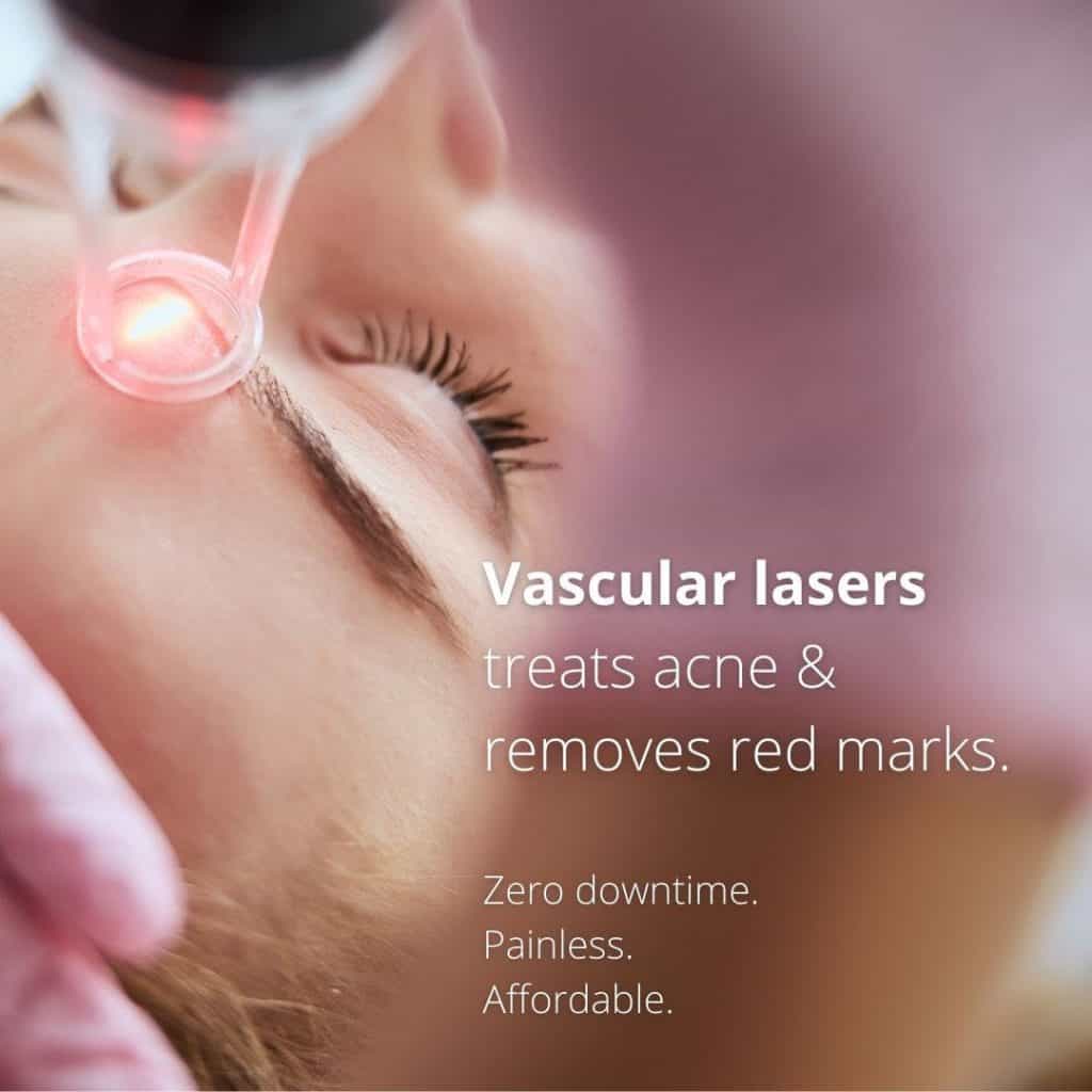 Skin Care: Acne Gallery - Dr Davin Lim