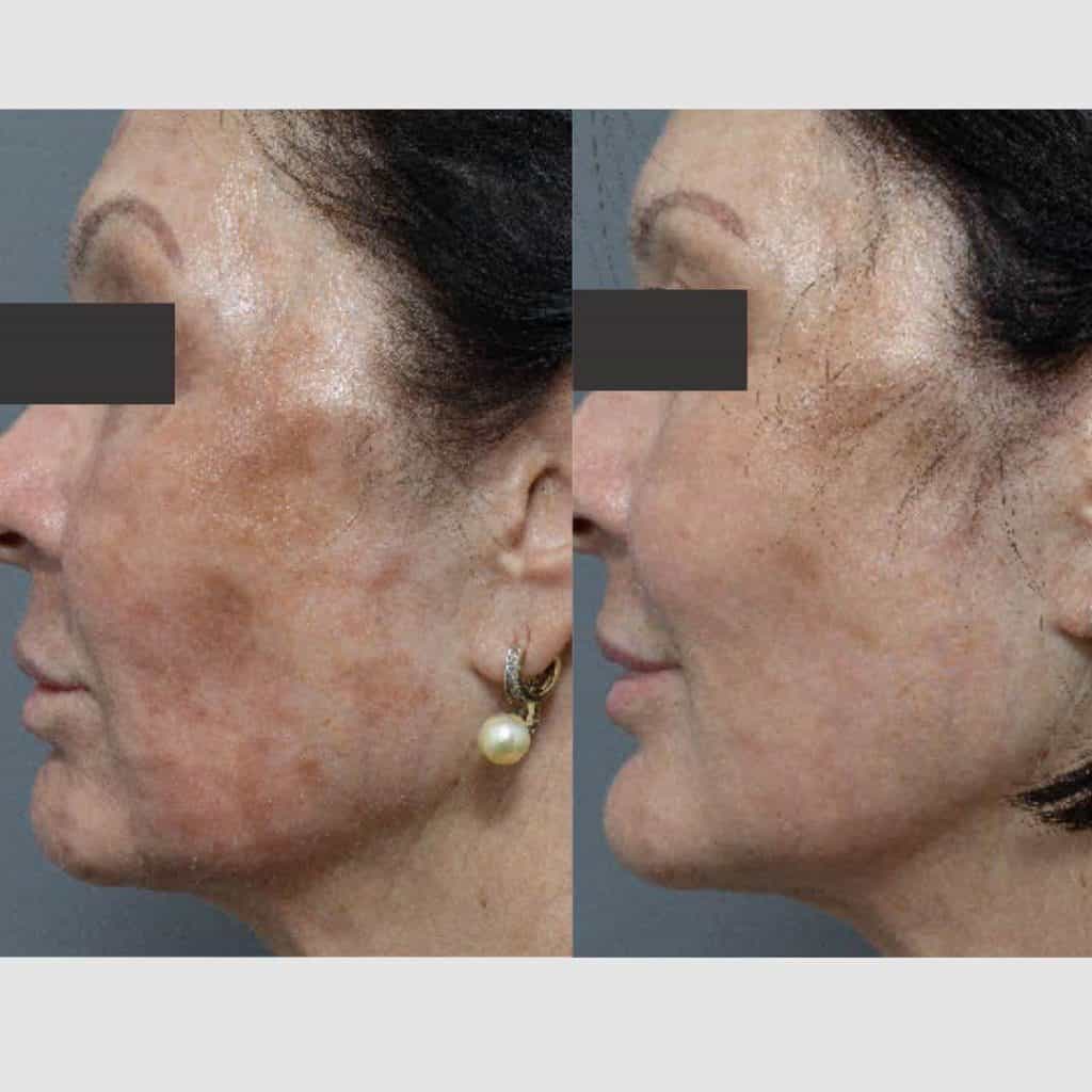 Post Inflammatory Hyperpigmentation Gallery - Dr Davin Lim