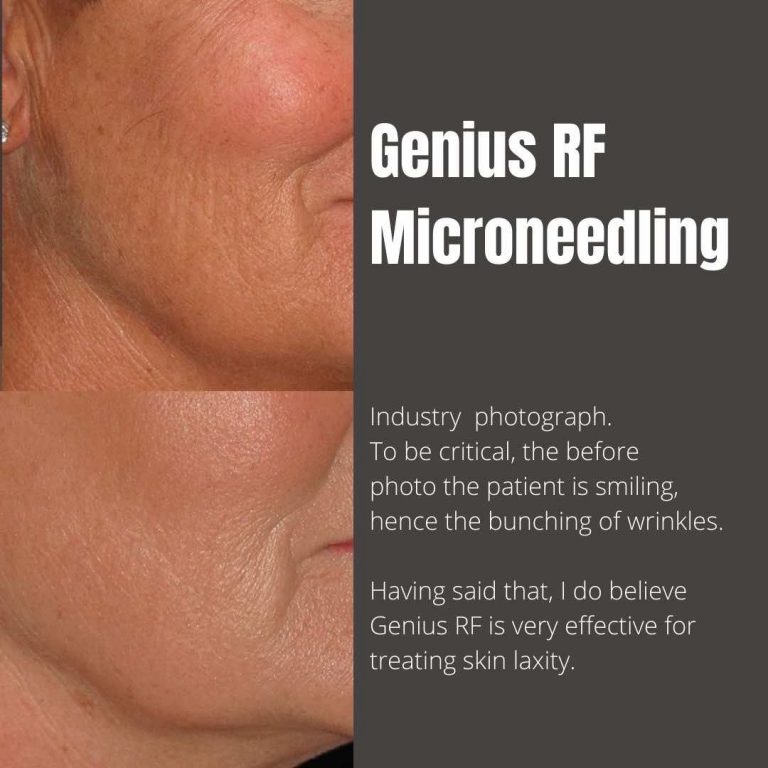 Skin Tightening Gallery - Dr Davin Lim