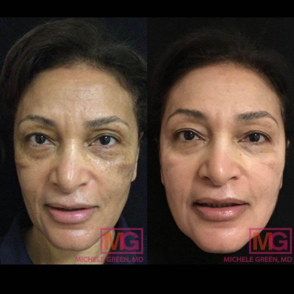 Chemical Peel Gallery - Dr Davin Lim