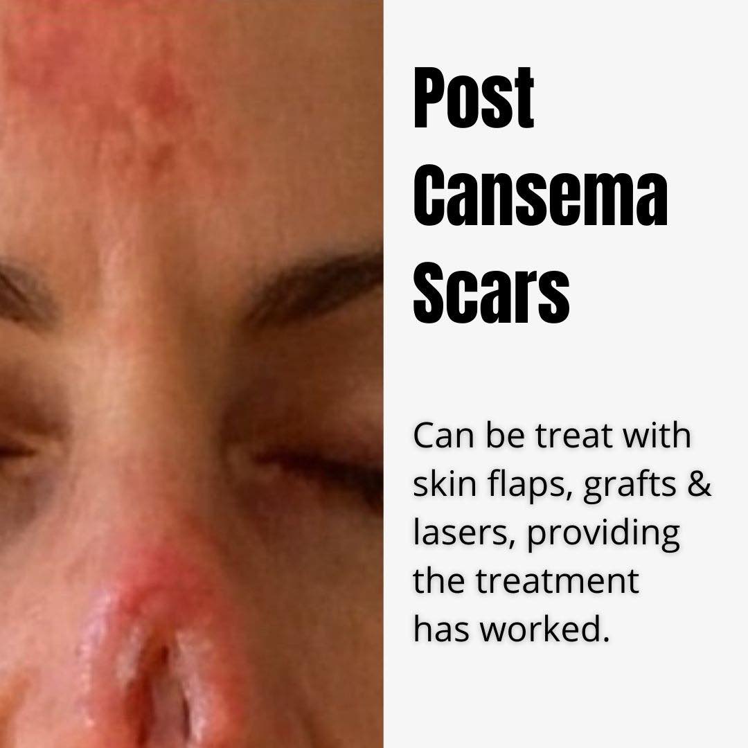 Best Cansema Treatment