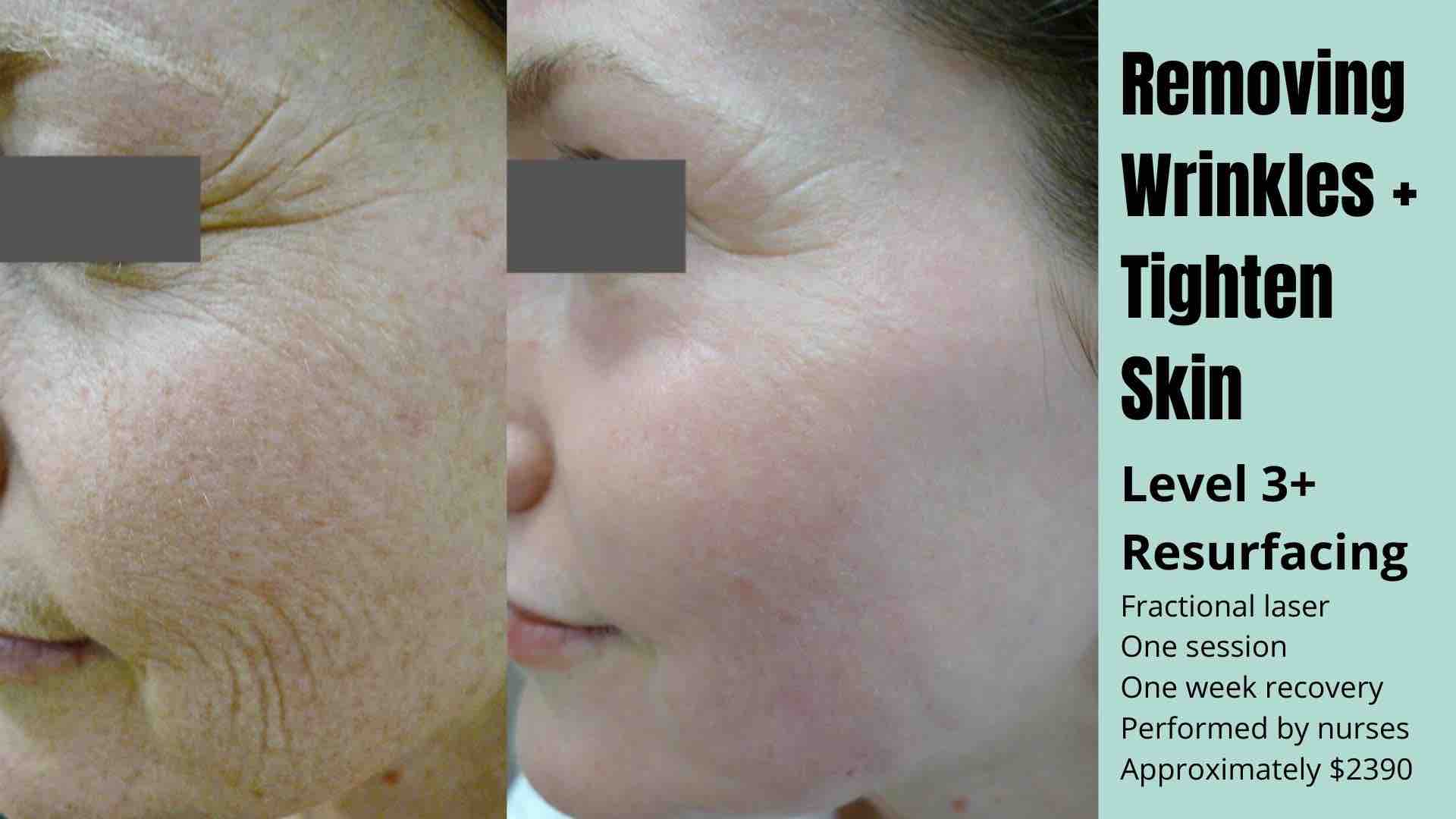Skin Tightening (How To) - Dr Davin Lim