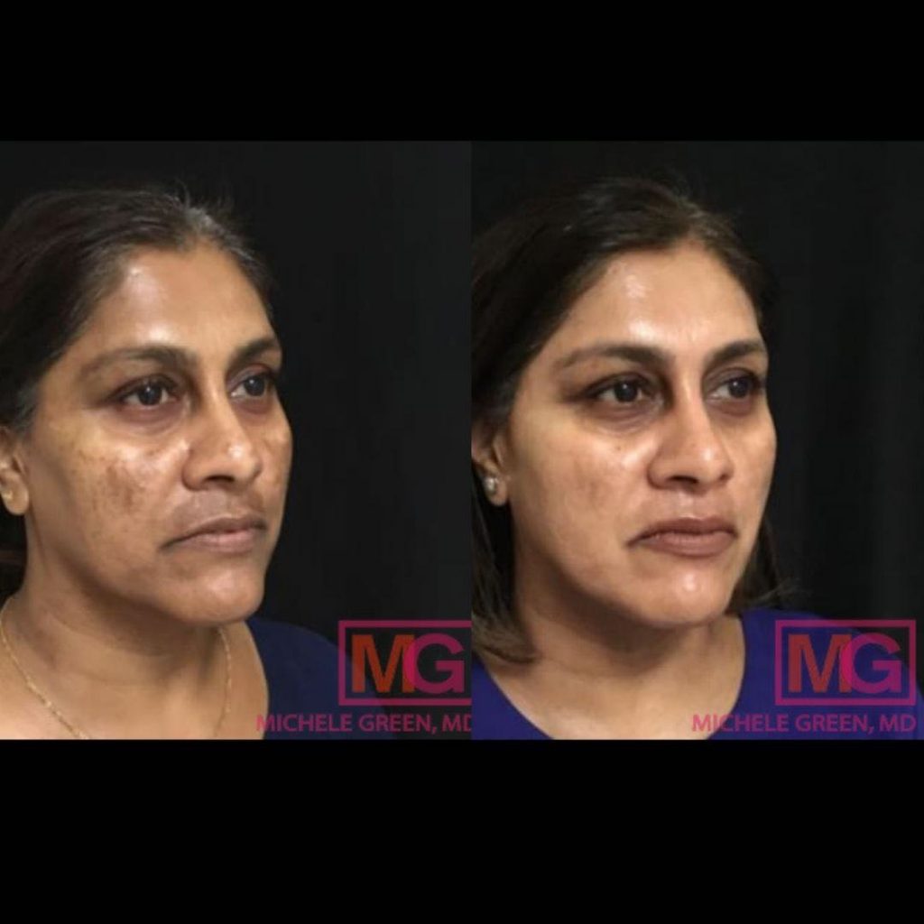 Chemical Peel Gallery - Dr Davin Lim