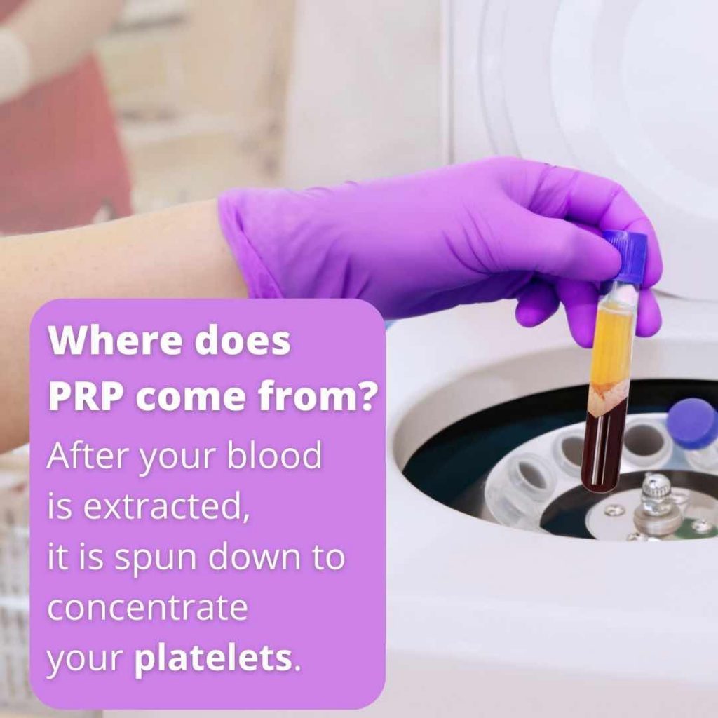 PRP Platelet Rich Plasma - Dr Davin Lim