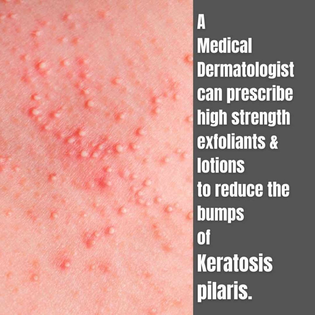 Best Keratosis Pilaris Treatment In Australia | Dr Davin Lim