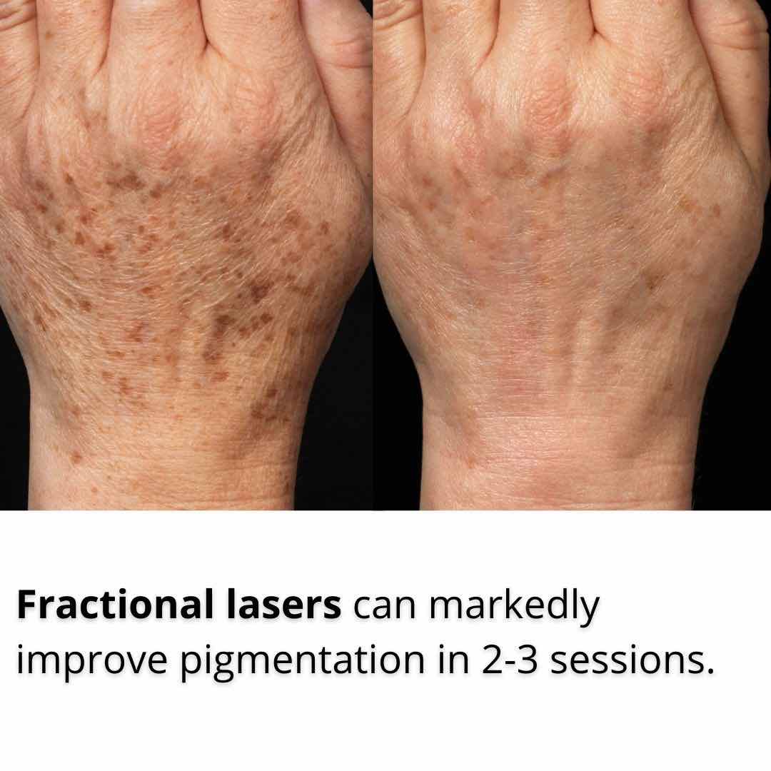 Best Aging Hand Rejuvenation Treatments In Australia