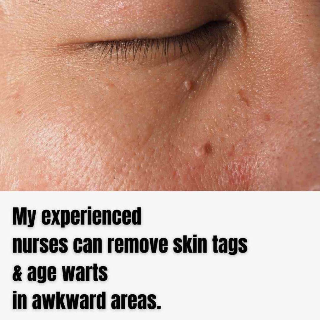 Age Warts - Seborrhoeic Keratosis - Dr Davin Lim