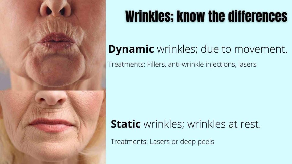 Wrinkles Perioral / Mouth - Dr Davin Lim