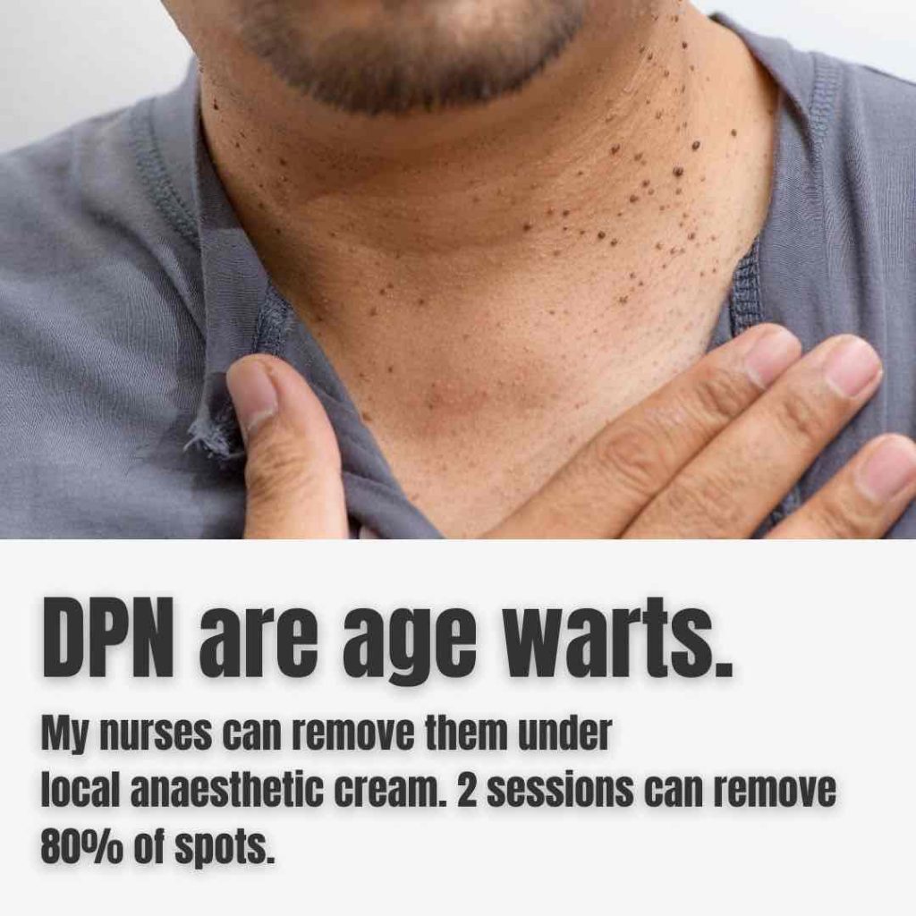 Age Warts - Seborrhoeic Keratosis - Dr Davin Lim