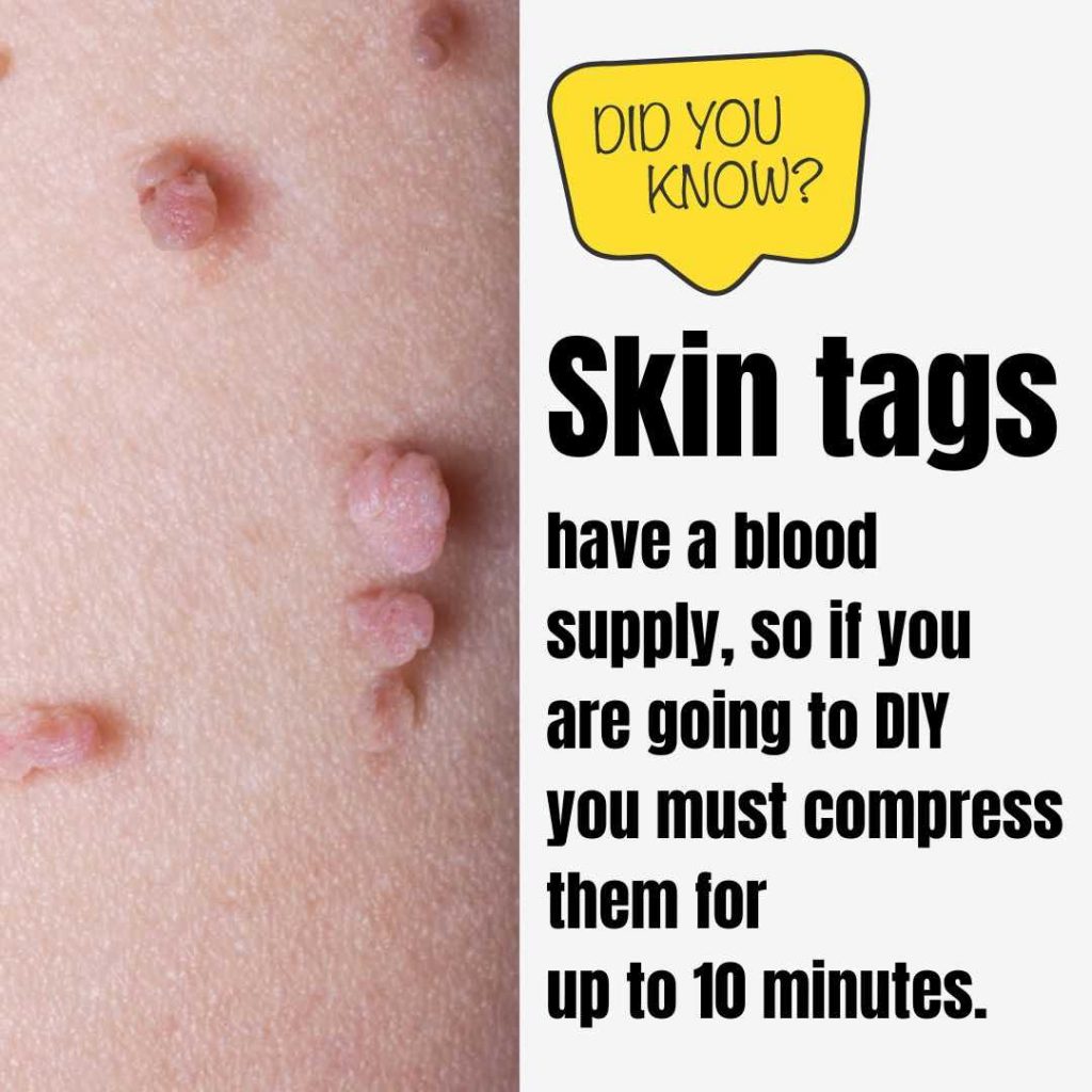 Age Warts - Seborrhoeic Keratosis - Dr Davin Lim