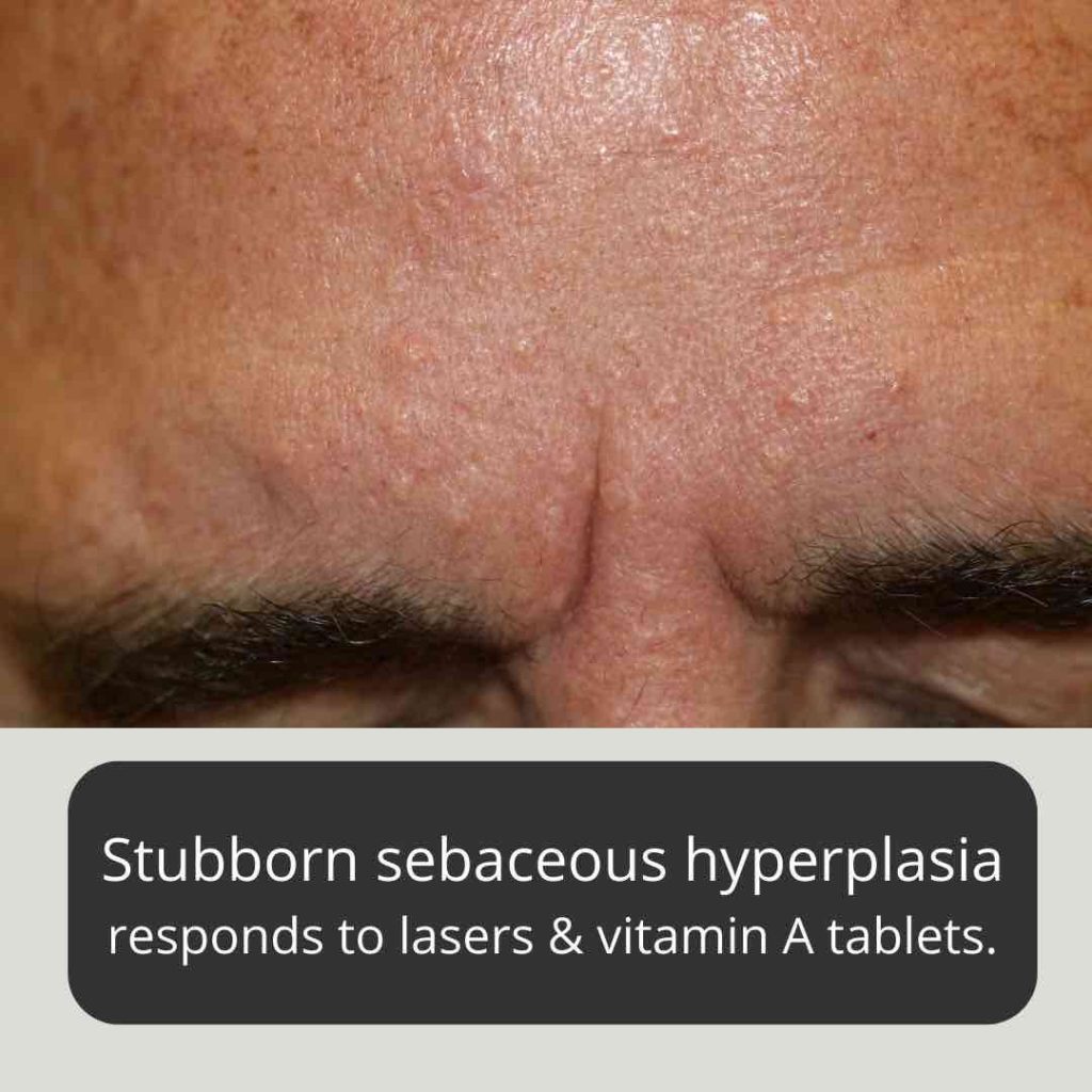 Best Sebaceous Hyperplasia Treatments In Australia