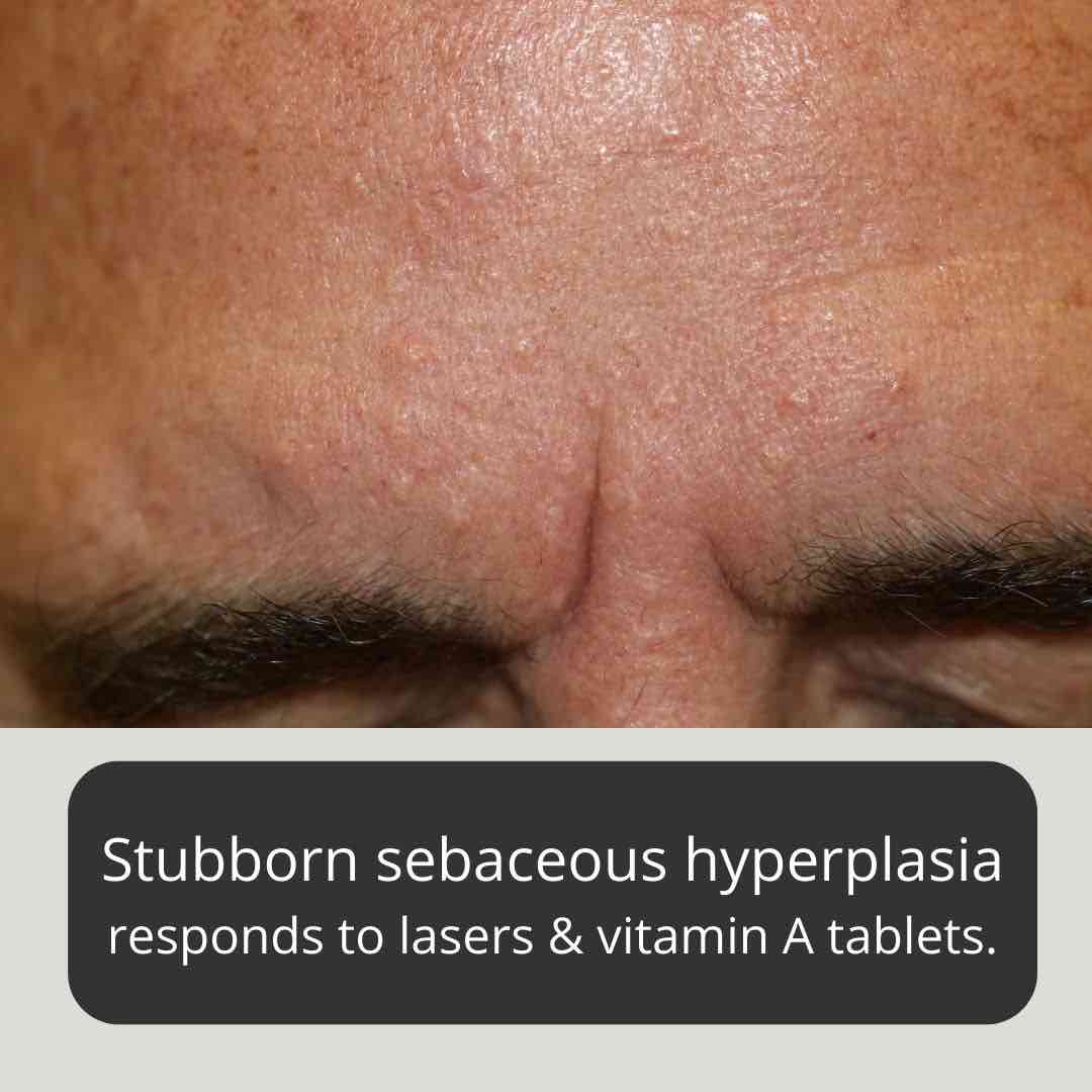 Best Sebaceous Hyperplasia Treatments In Australia