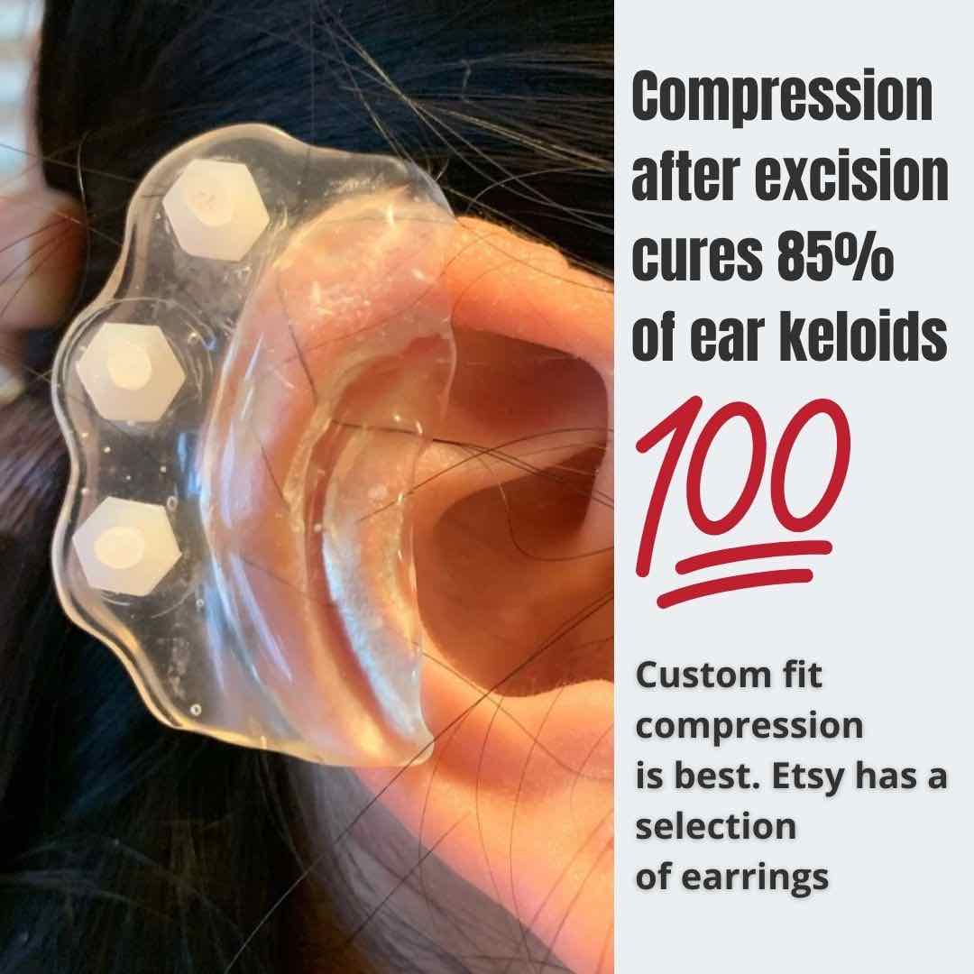 Best Ear Keloids Scars Treatment In Brisbane | Dr Davin Lim