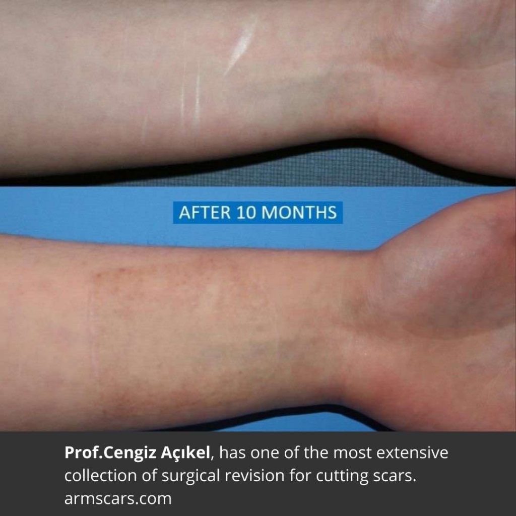Self-Harm Scars - Laser Removal - Dr Davin Lim