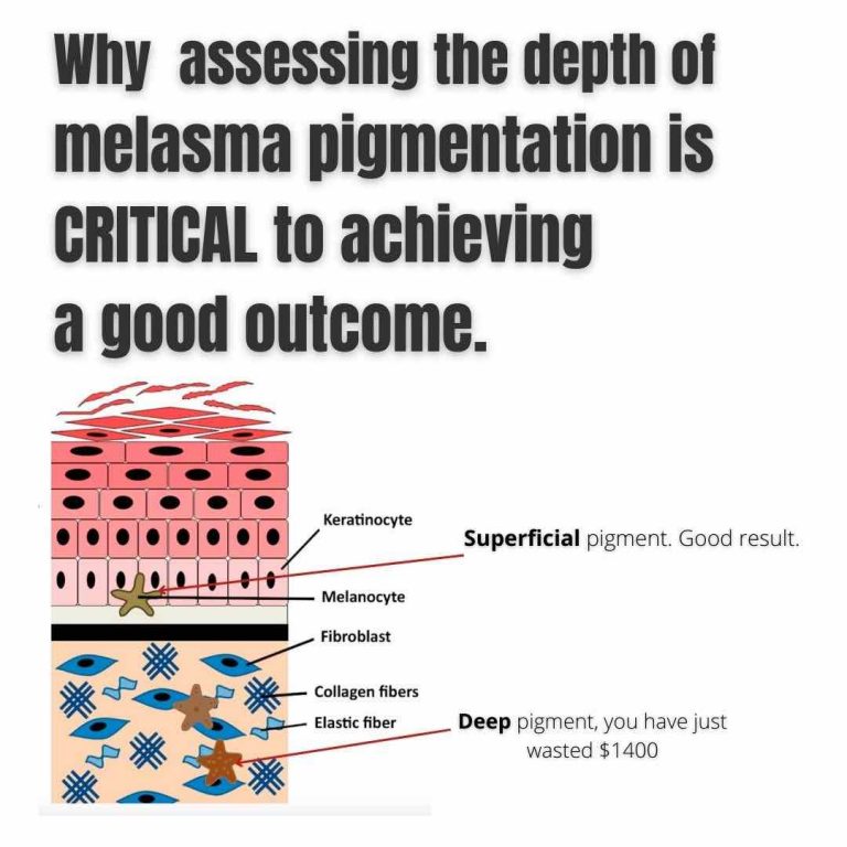 Best Melasma Microneedling In Australia | Dr Davin Lim