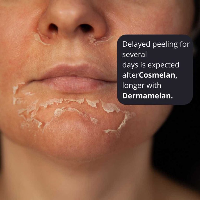 Best Dermamelan Peel Treatment In Brisbane | Dr Davin Lim