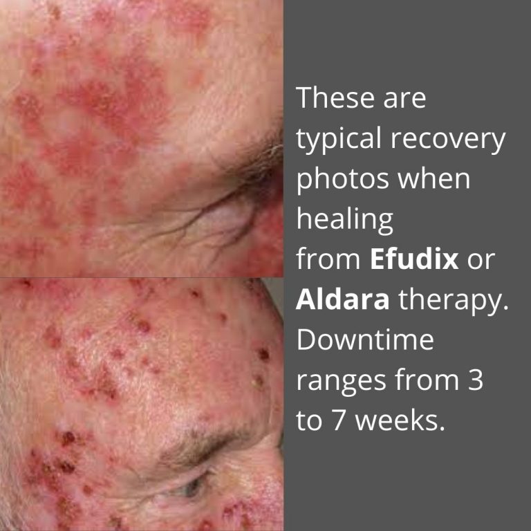 Best Efudix For Sun Spots Treatment In Brisbane | Dr Davin Lim