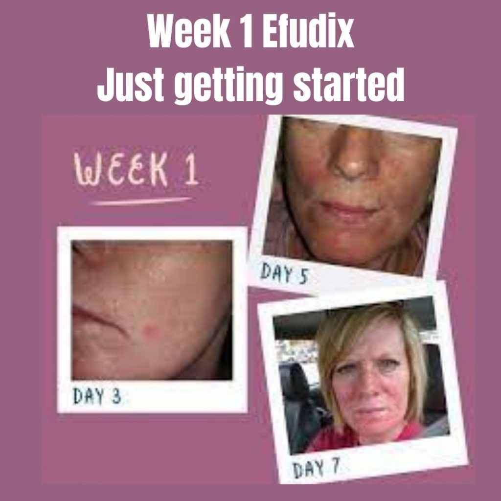 Best Efudix For Sun Spots Treatment In Brisbane | Dr Davin Lim