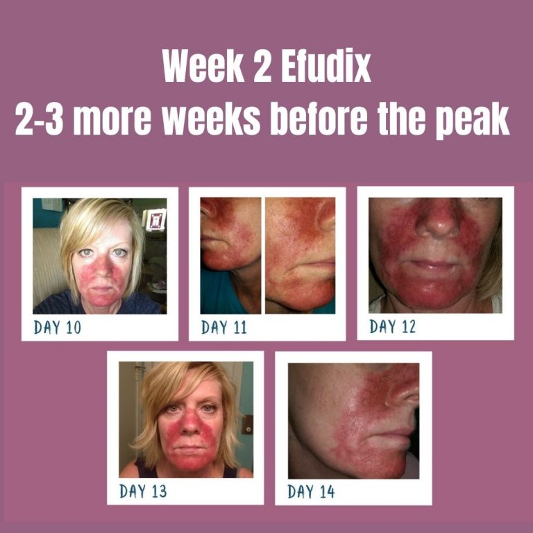 Best Efudix For Sun Spots Treatment In Brisbane | Dr Davin Lim