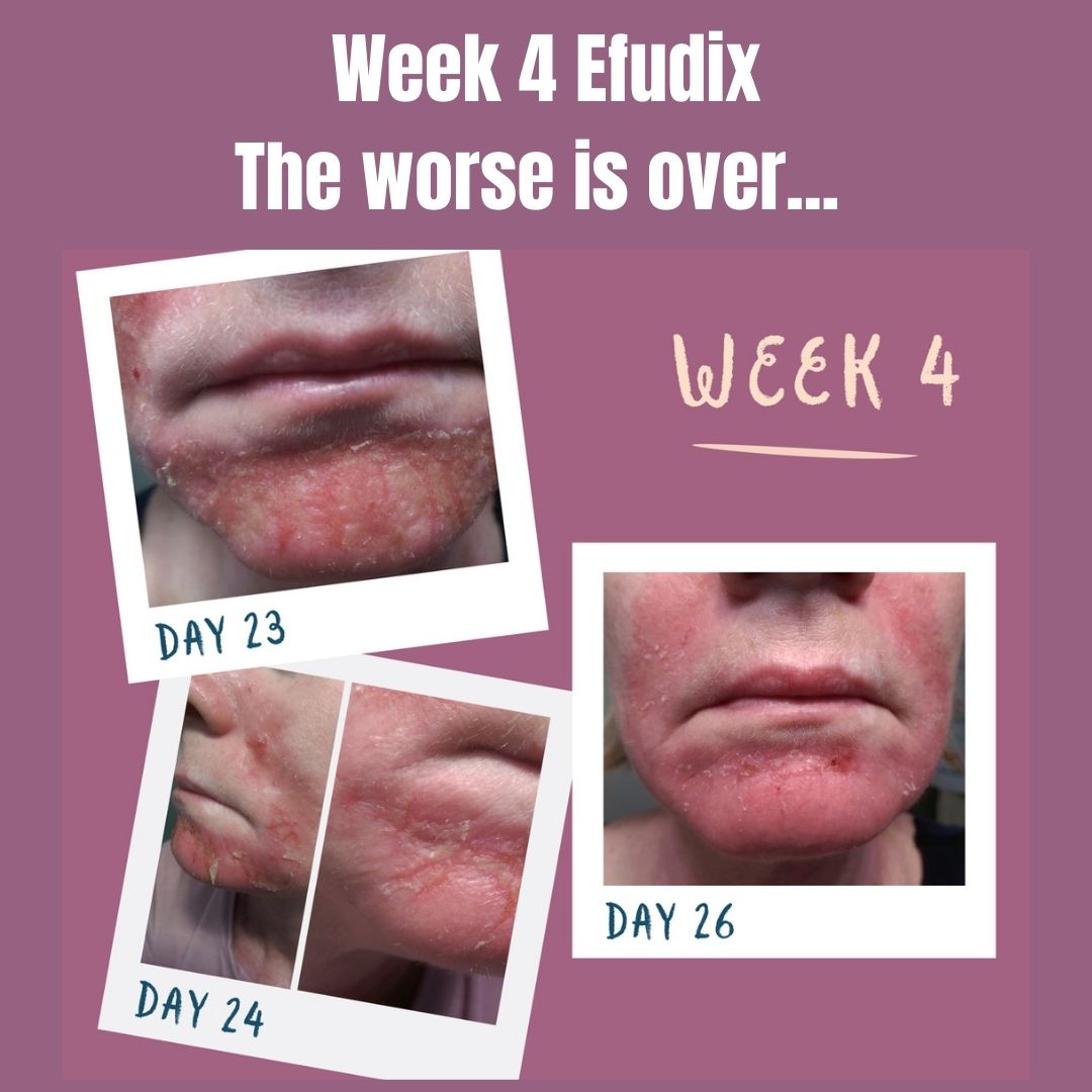 Best Efudix For Sun Spots Treatment In Brisbane | Dr Davin Lim