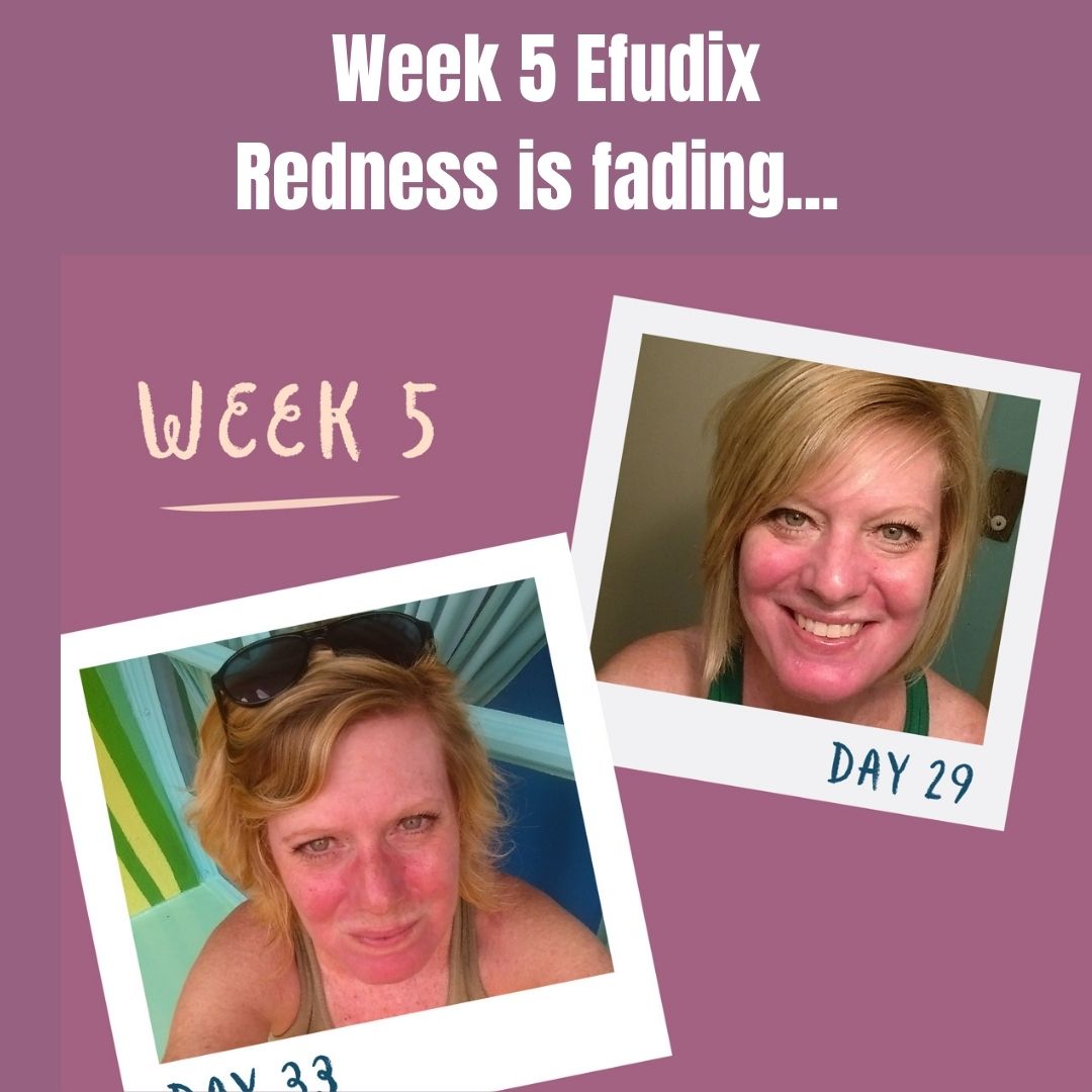 Best Efudix For Sun Spots Treatment In Brisbane | Dr Davin Lim