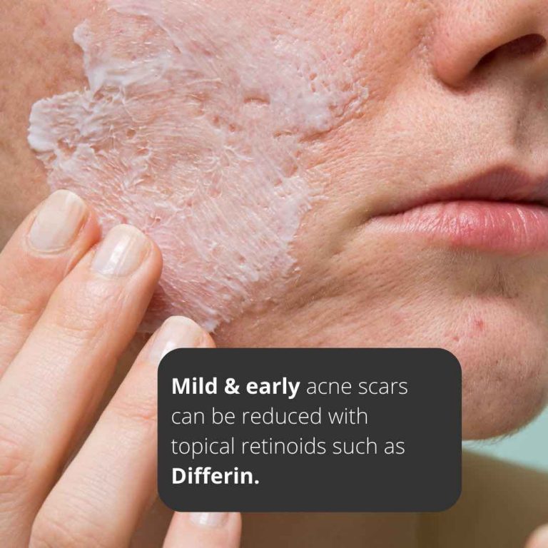 Best Creams For Treating Acne In Australia | Dr Davin Lim
