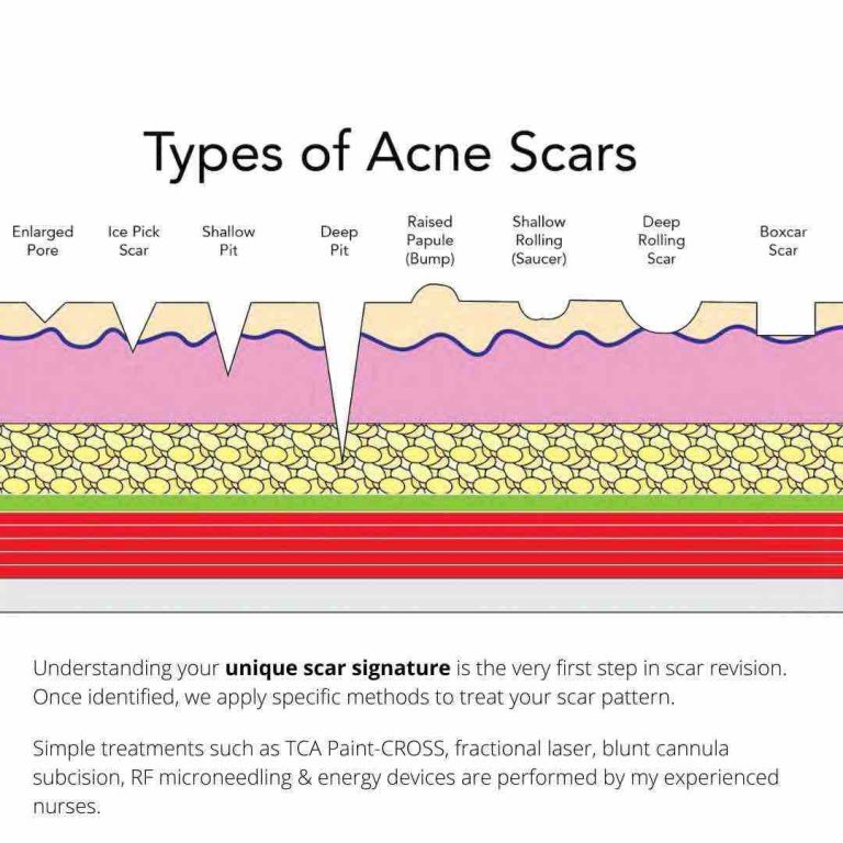 Best Acne Scar Revision In Australia | Dr Davin Lim