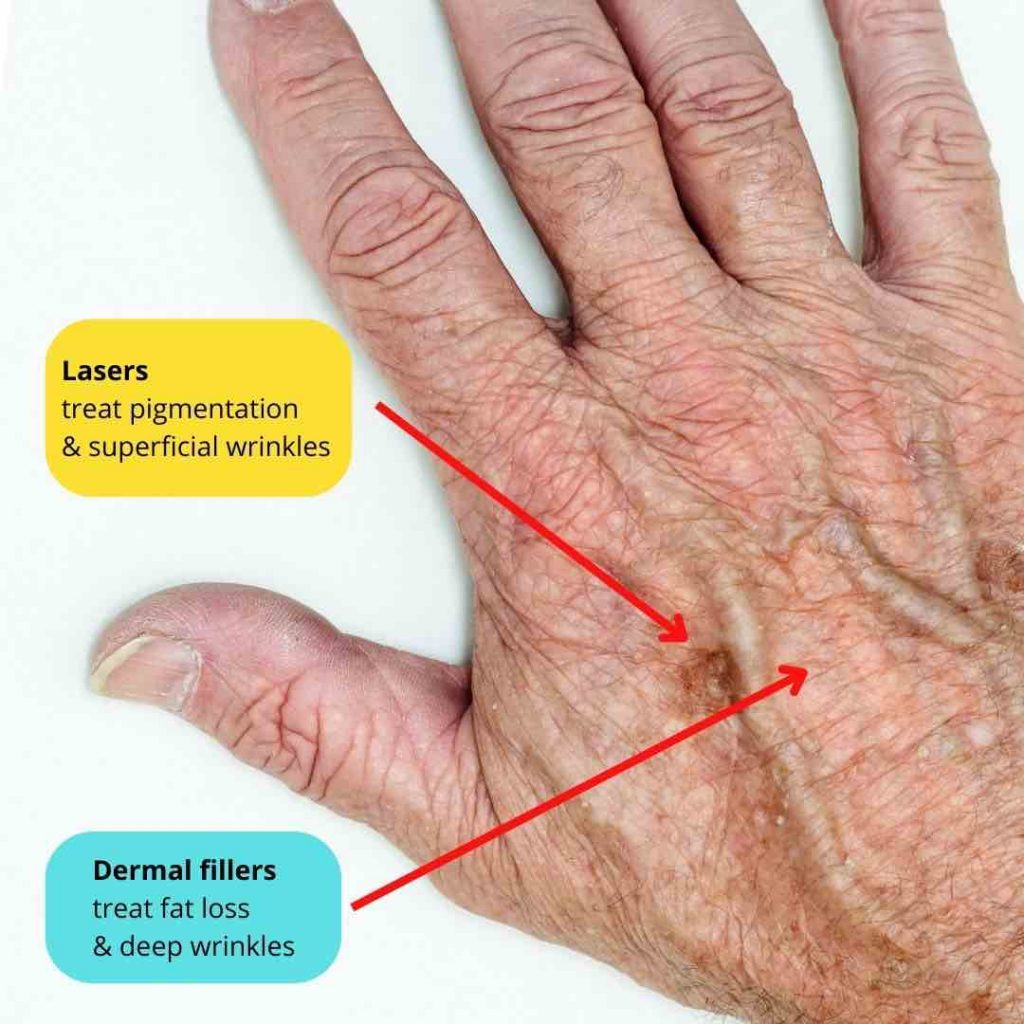 Best Aging Hand Rejuvenation Treatments In Australia