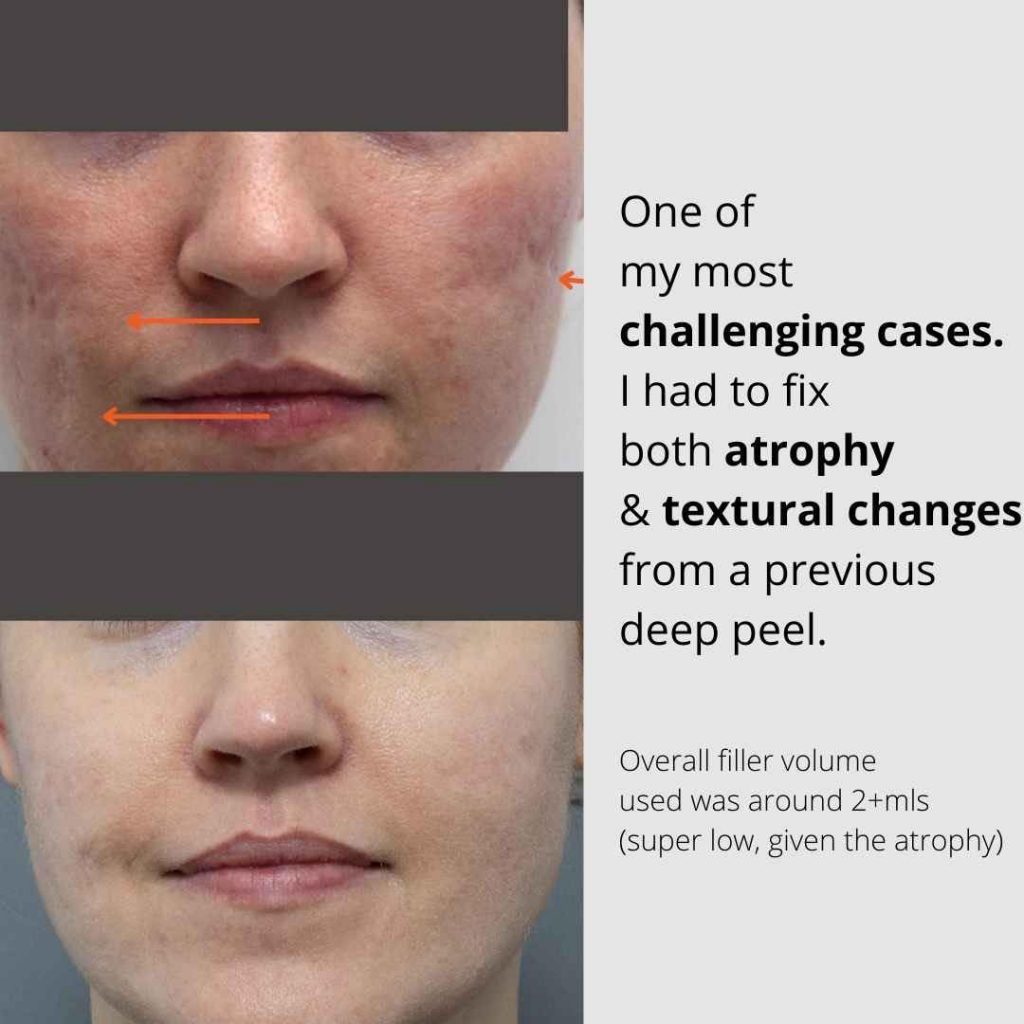 Best Hormonal Acne Treatment In Australia | Dr Davin Lim