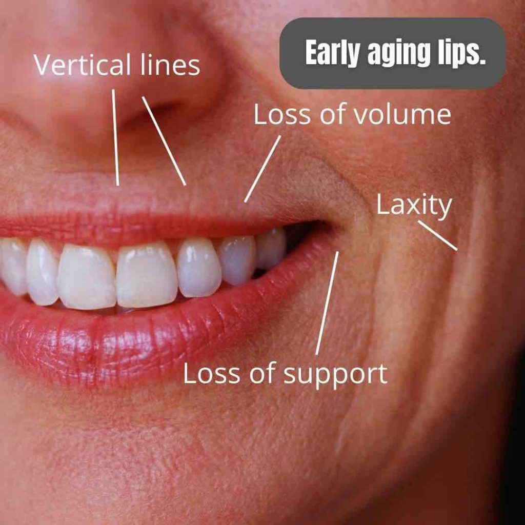 Wrinkles Perioral / Mouth - Dr Davin Lim