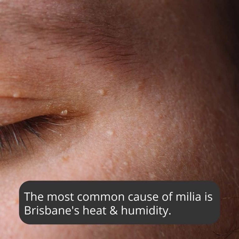 Best Milia Treatments In Australia 2026 | Dr Davin Lim