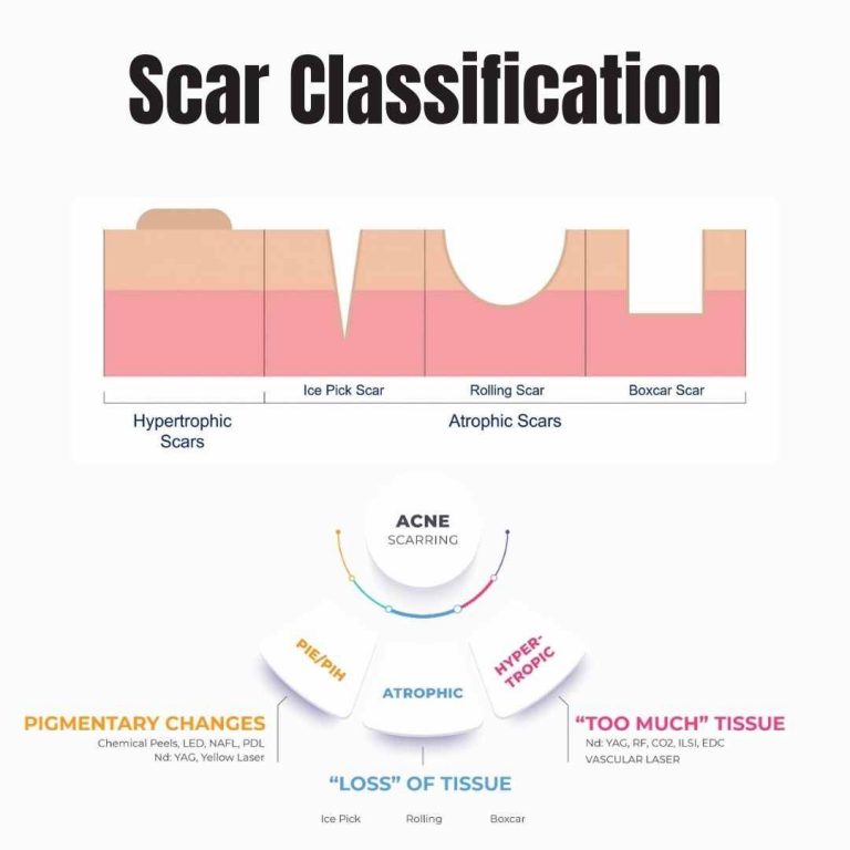 TCA Cross Acne Scars Treatment In Australia | Dr Davin Lim