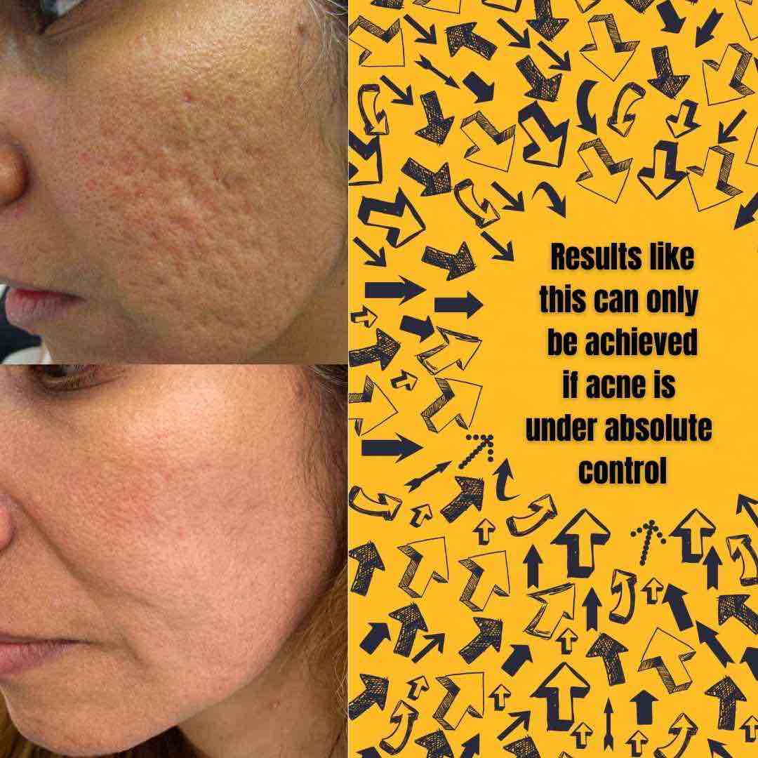 Best Taylor Liberator Subcision Treatment In Australia