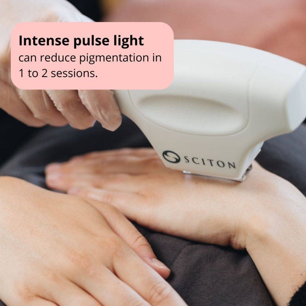 Hand Wrinkles - Dr Davin Lim