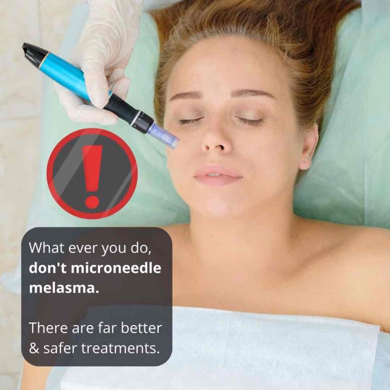 Best Melasma Treatments In Australia | Dr Davin Lim
