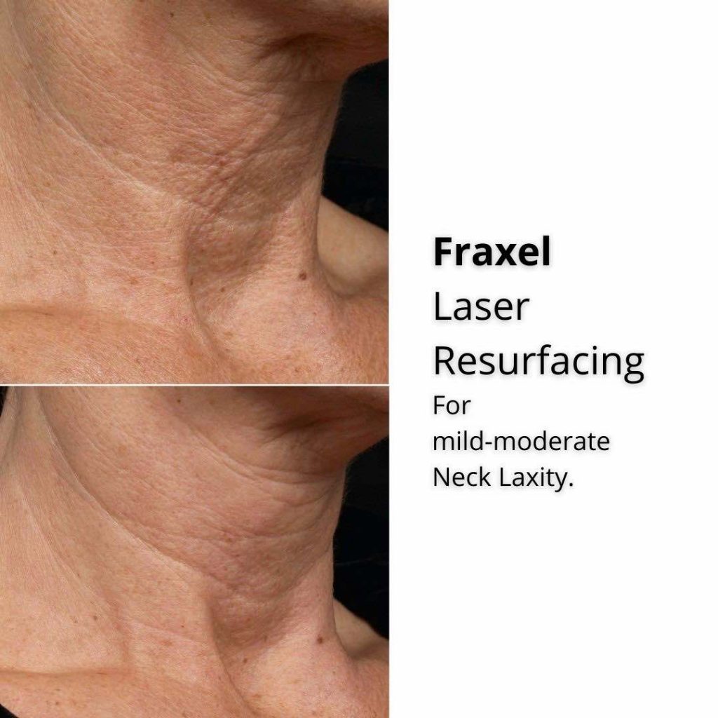 Best Chest Neck And Décolletage Solutions In Australia