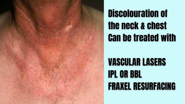 Best Chest Neck And Décolletage Solutions In Australia