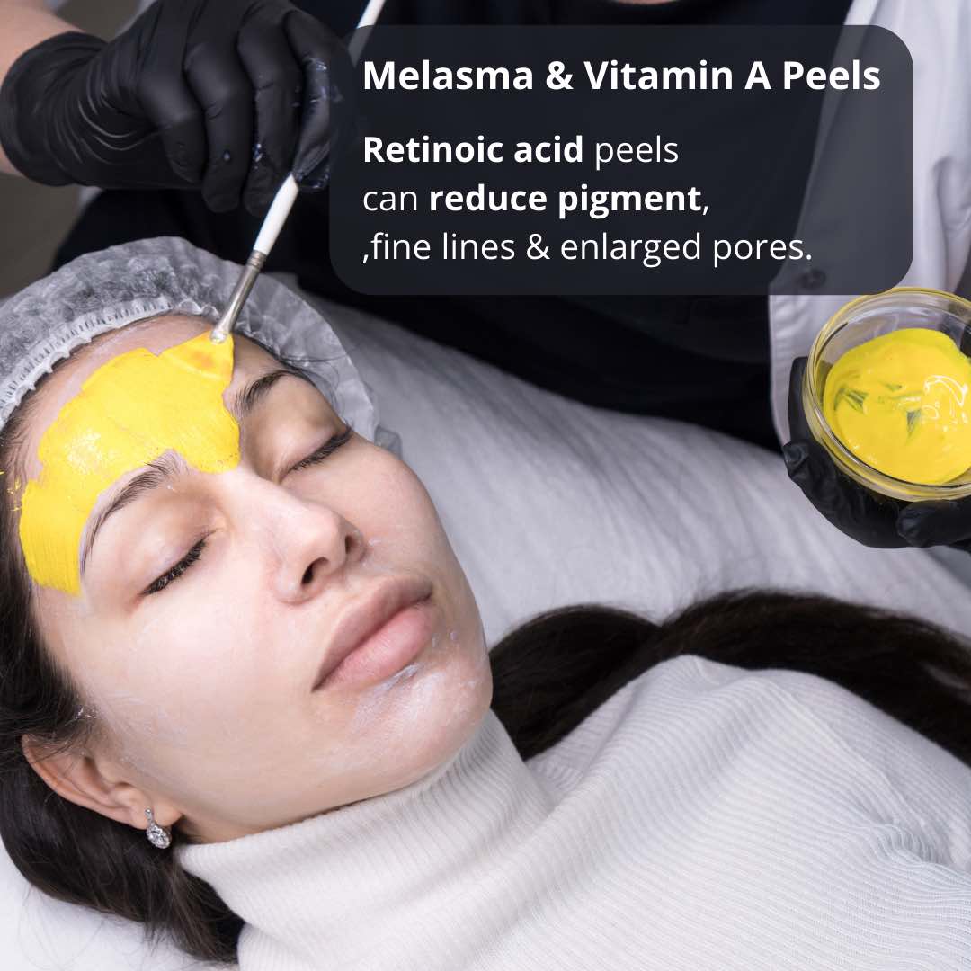 Best Melasma Treatments In Australia | Dr Davin Lim