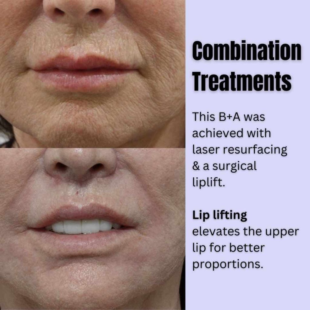Best Upper Lip Lines Treatment In Australia | Dr Davin Lim