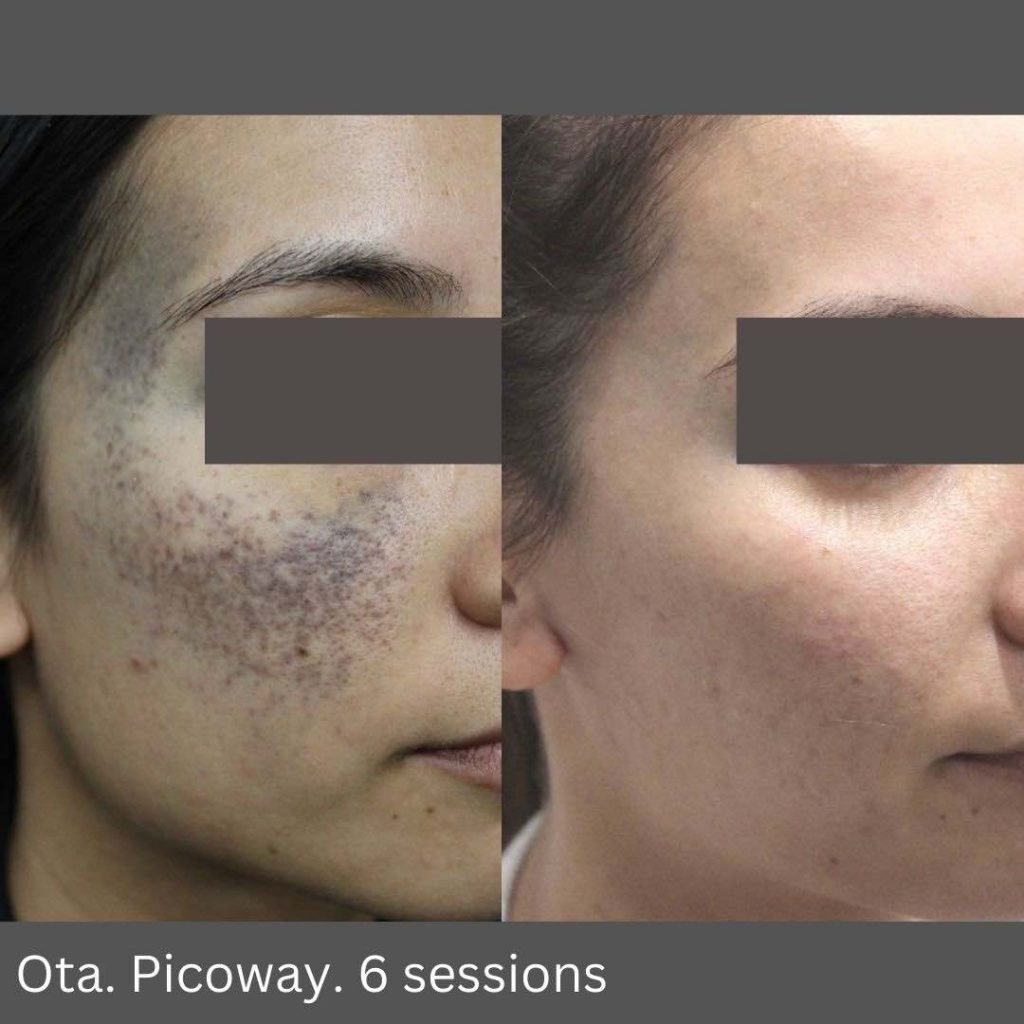 Birthmarks Gallery - Dr Davin Lim